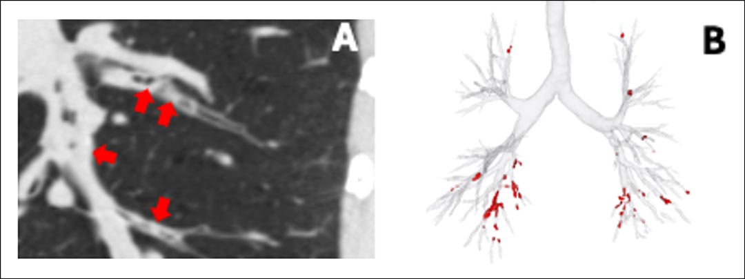 A sticky road: Mucus pathology in COPD - CHEST Physician