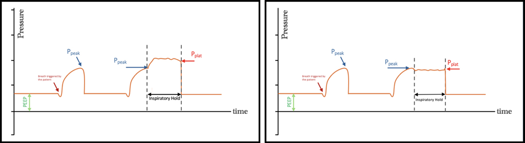 Striking the right balance: Optimizing mechanical ventilation settings ...