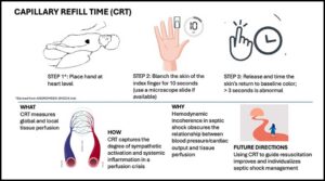 Capillary refill time: Advancing perfusion-targeted resuscitation in ...